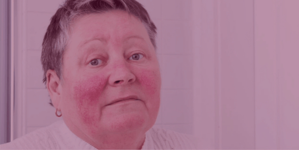 How Exercise Affects Rosacea And What You Can Do About It – SkinKitz
